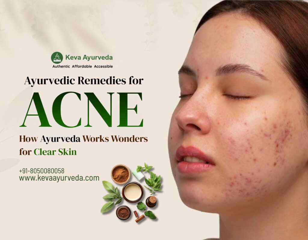 Ayurvedic Remedies for Acne: How Ayurveda Works Wonders for Clear Skin ...